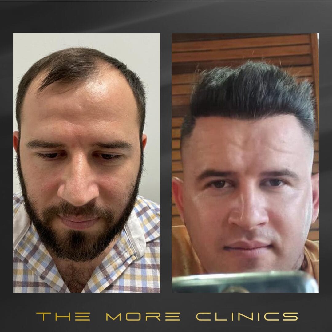 Dhi Hair Transplant: A Comprehensive Guide