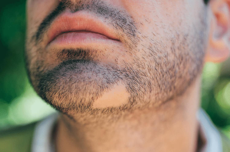 Alopecia Barbae Treatments Causes Symptoms The More Clinics
