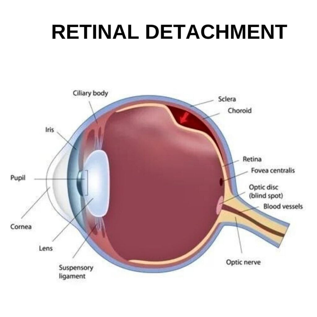 Retinal Detachment Symptoms, Causes and Treatment