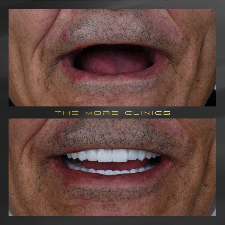 Dental Implants Turkey Cost - The More Clinics Best Choice