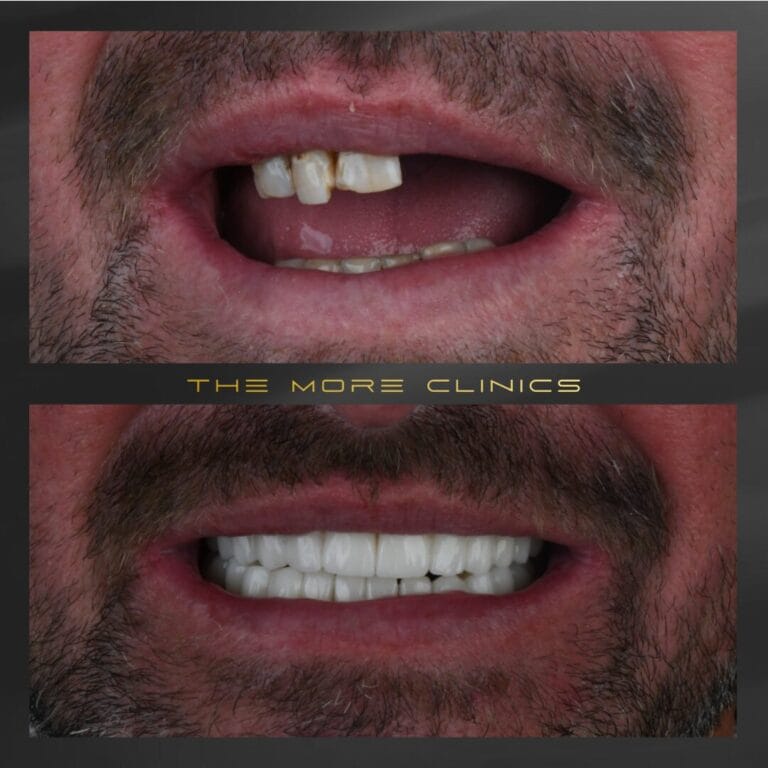 Dental Implants Turkey Cost - The More Clinics Best Choice