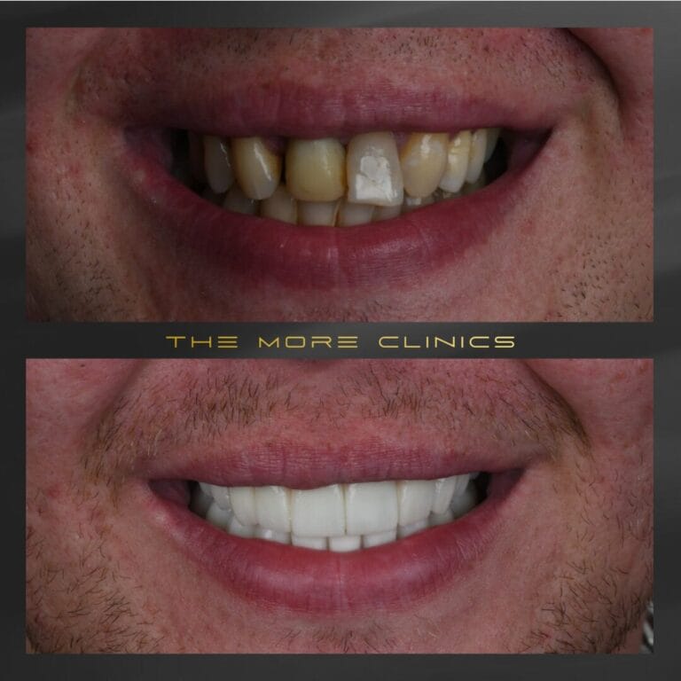 Dental Implants Turkey Cost - The More Clinics Best Choice