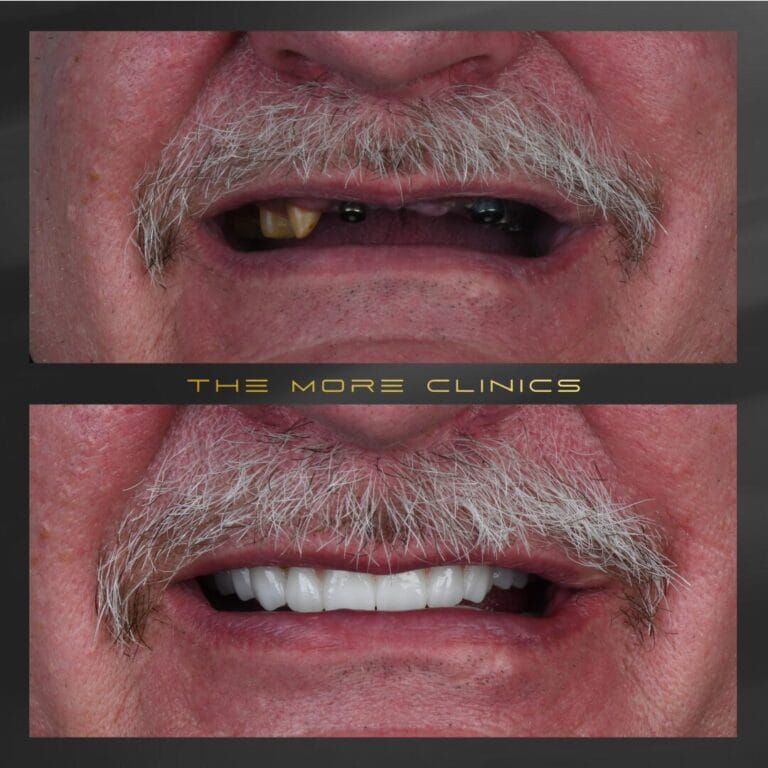 Dental Implants Turkey Cost - The More Clinics Best Choice