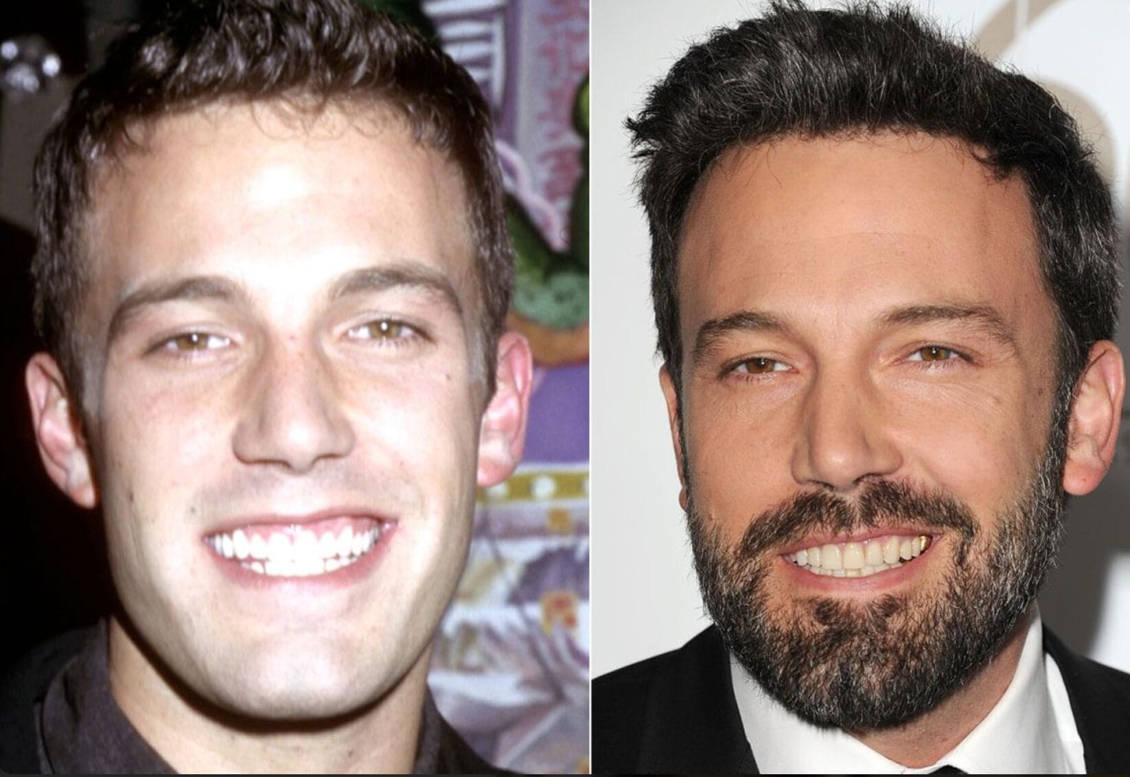 Celebrities with Veneers Before and After - The More Clinics