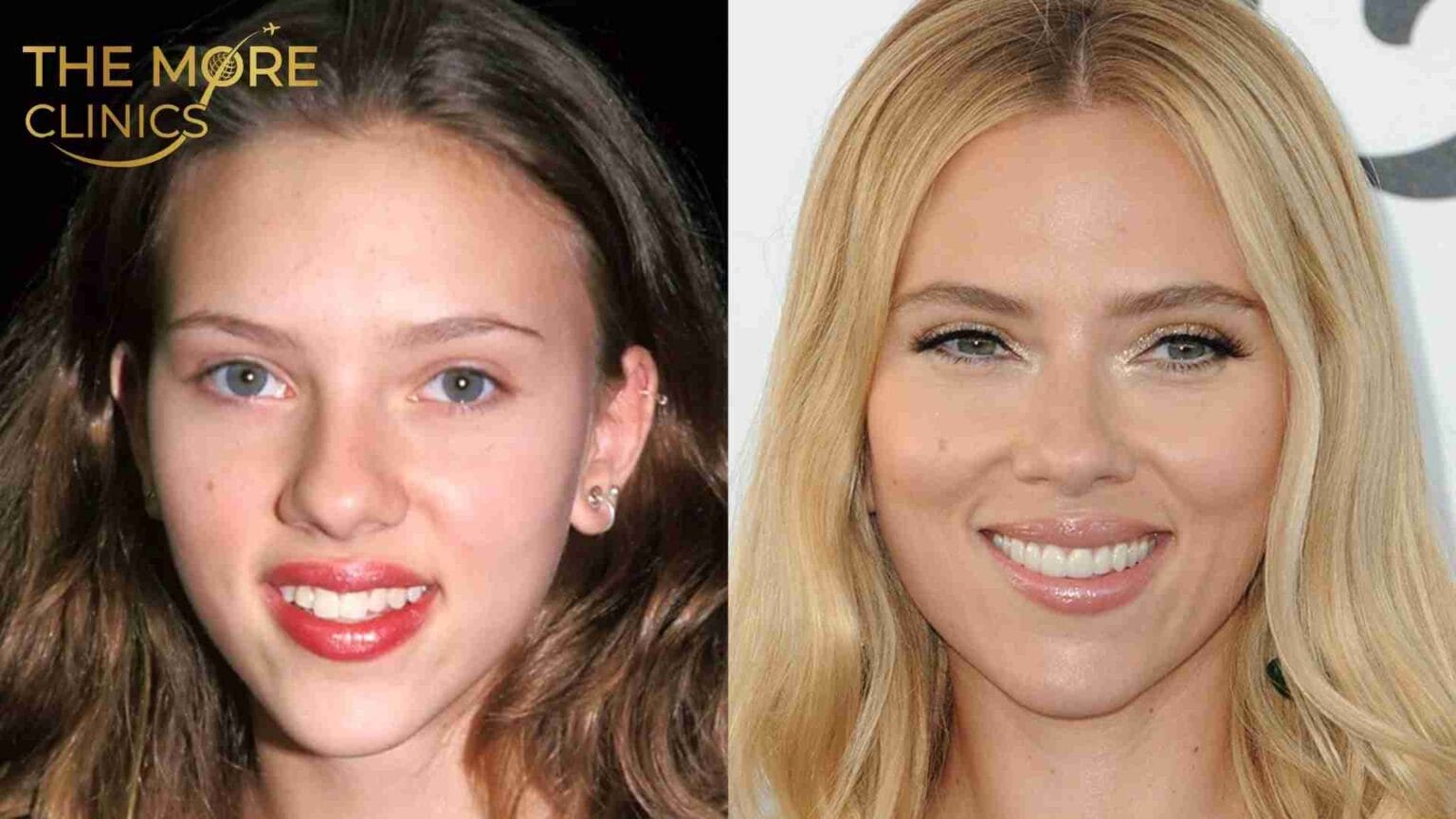 Celebrities with Veneers Before and After - The More Clinics