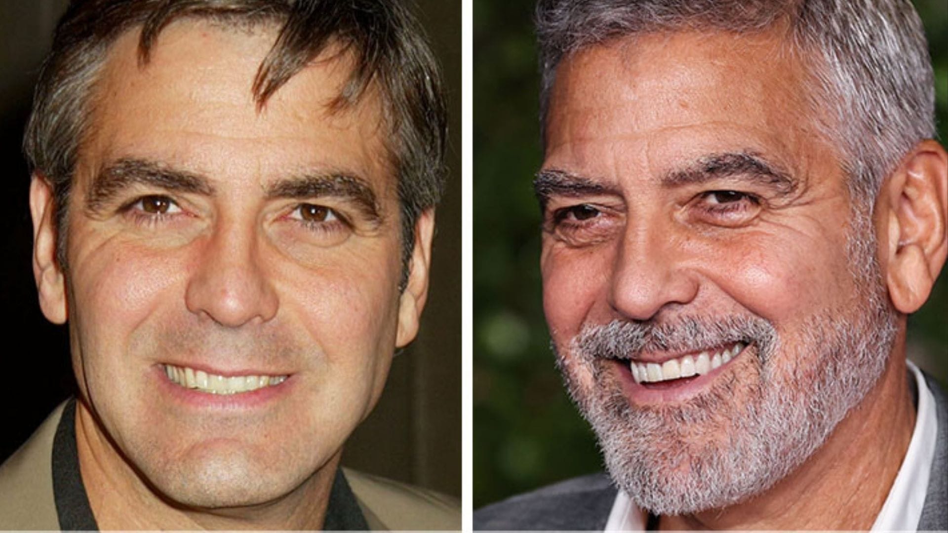 Celebrities with Veneers Before and After - The More Clinics