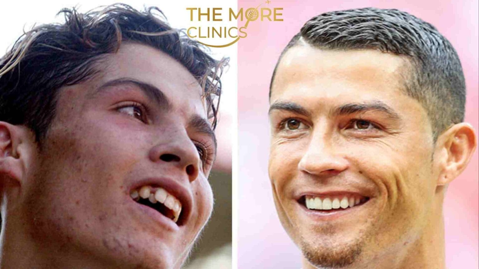 Celebrities with Veneers Before and After - The More Clinics