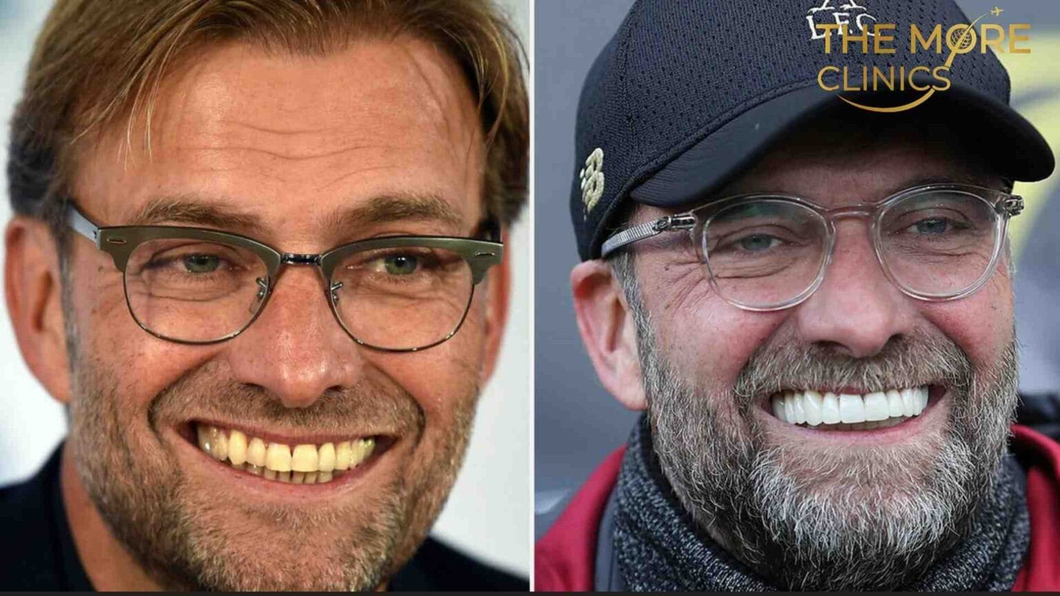 Celebrities with Veneers Before and After - The More Clinics