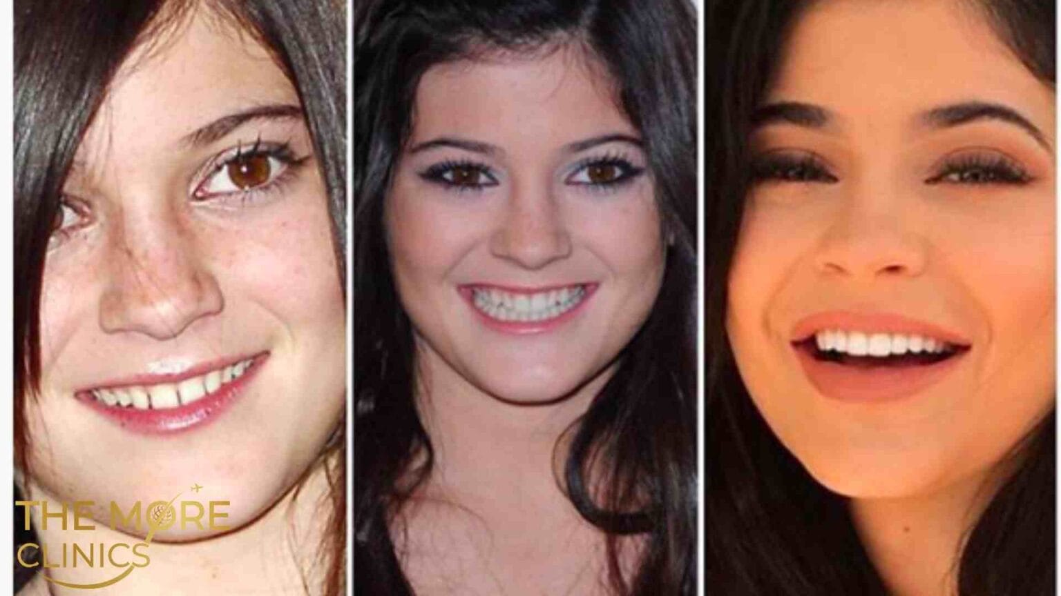 Celebrities with Veneers Before and After - The More Clinics