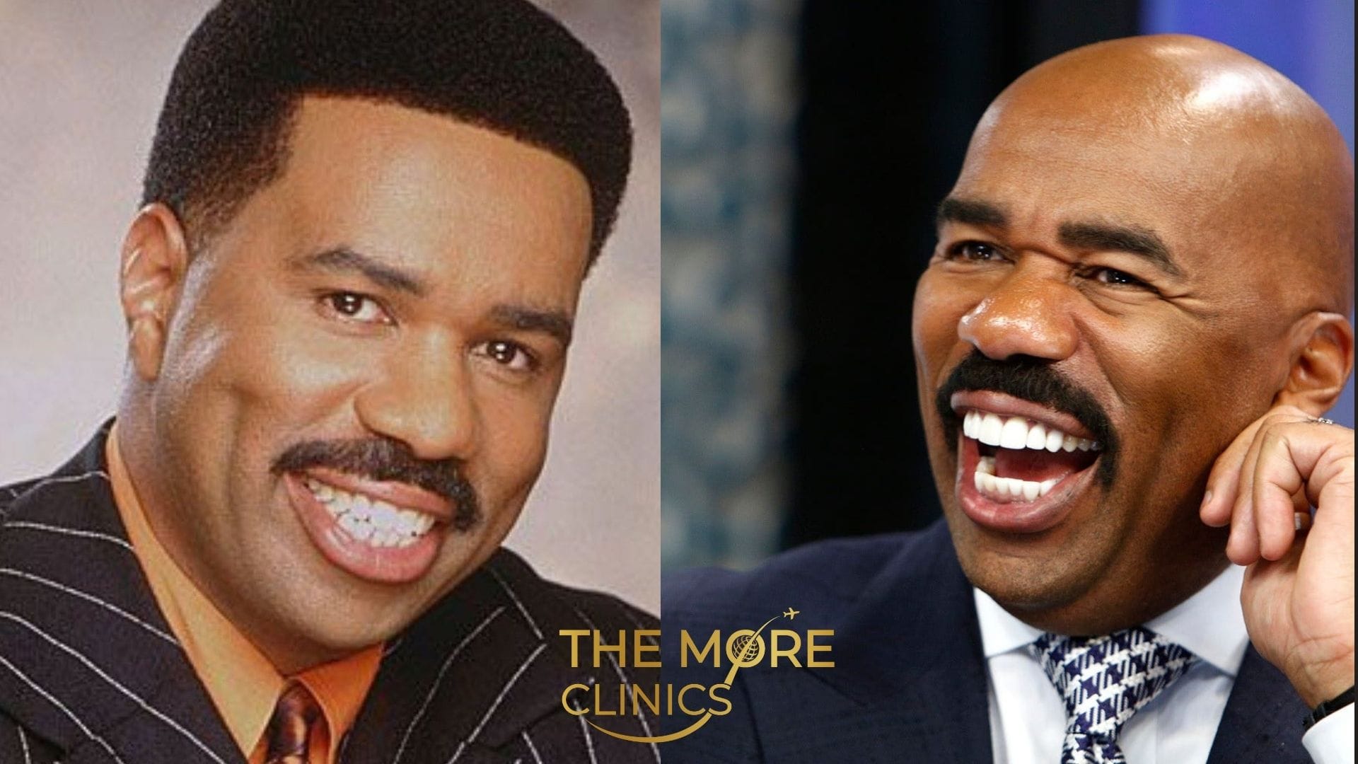 Celebrities with Veneers Before and After - The More Clinics