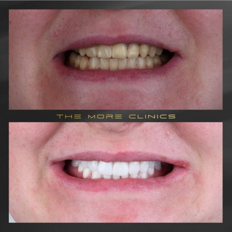 Tom Cruise Teeth Before and After Transformation in Details