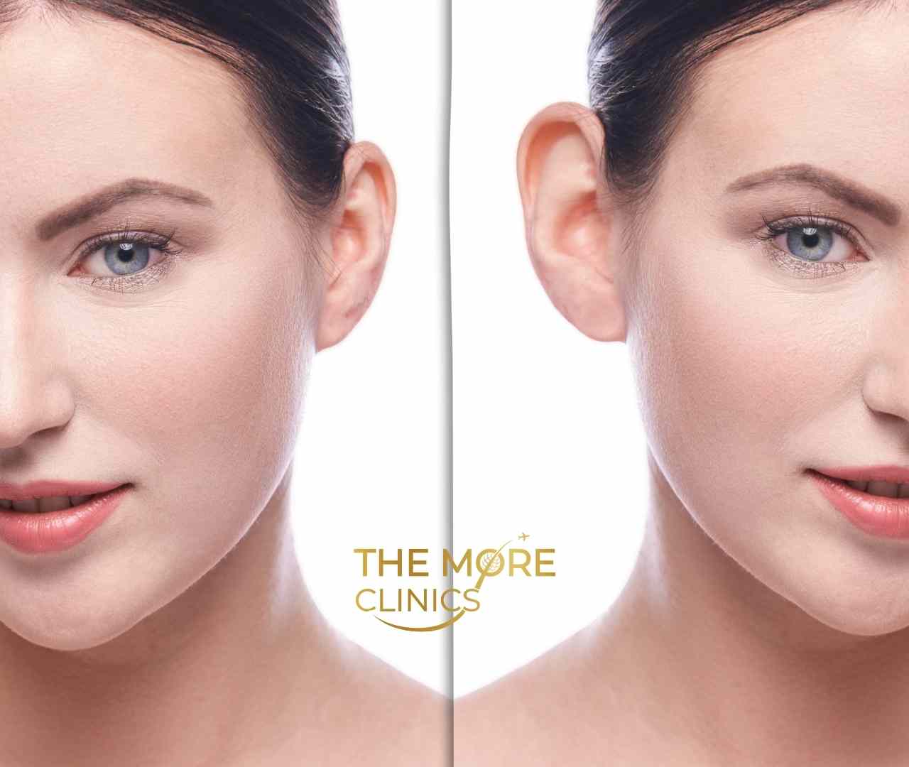 Otoplasty Turkey Price & Surgery - The More Clinics