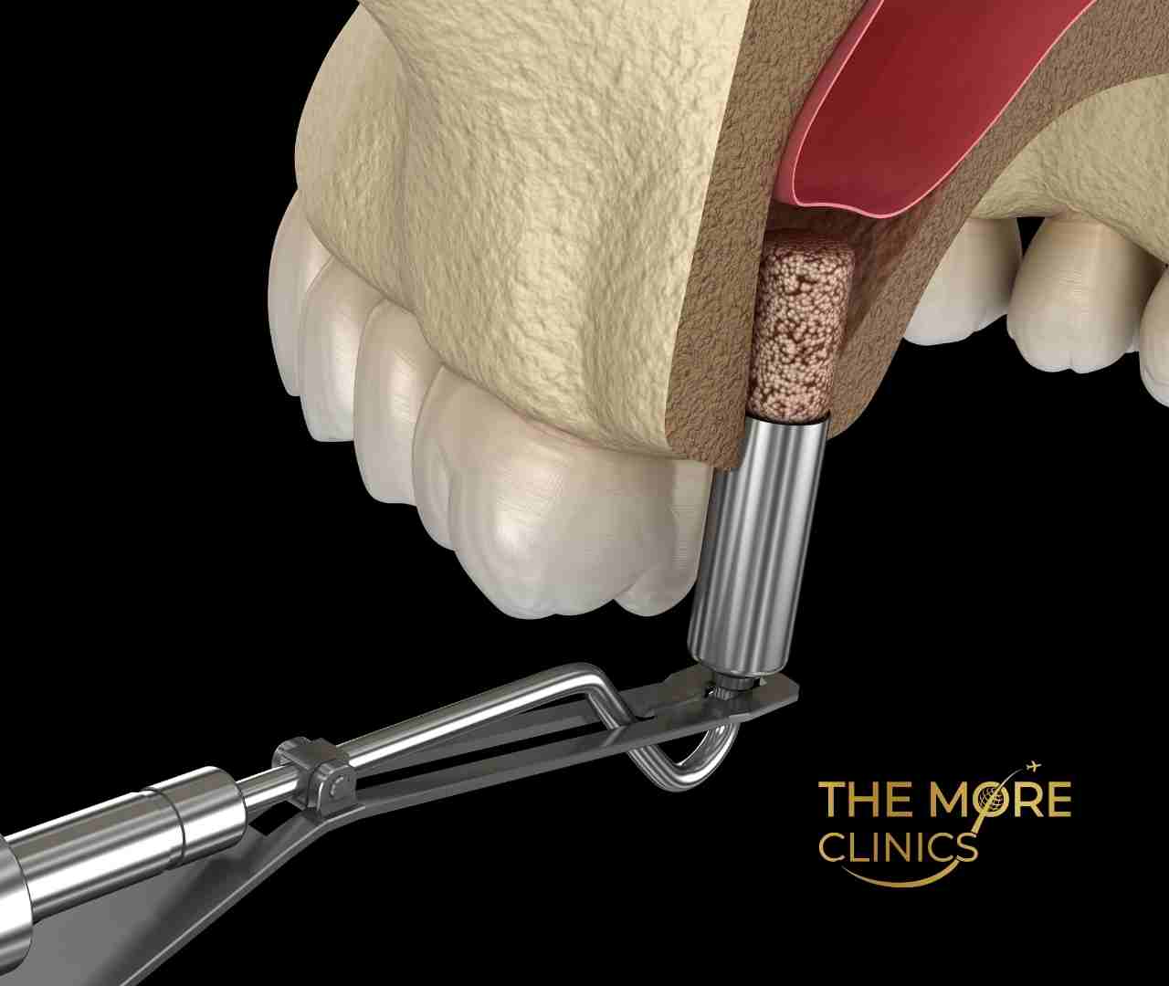 Sinus Lift Surgery - Cost - Sinus Lift and Implant