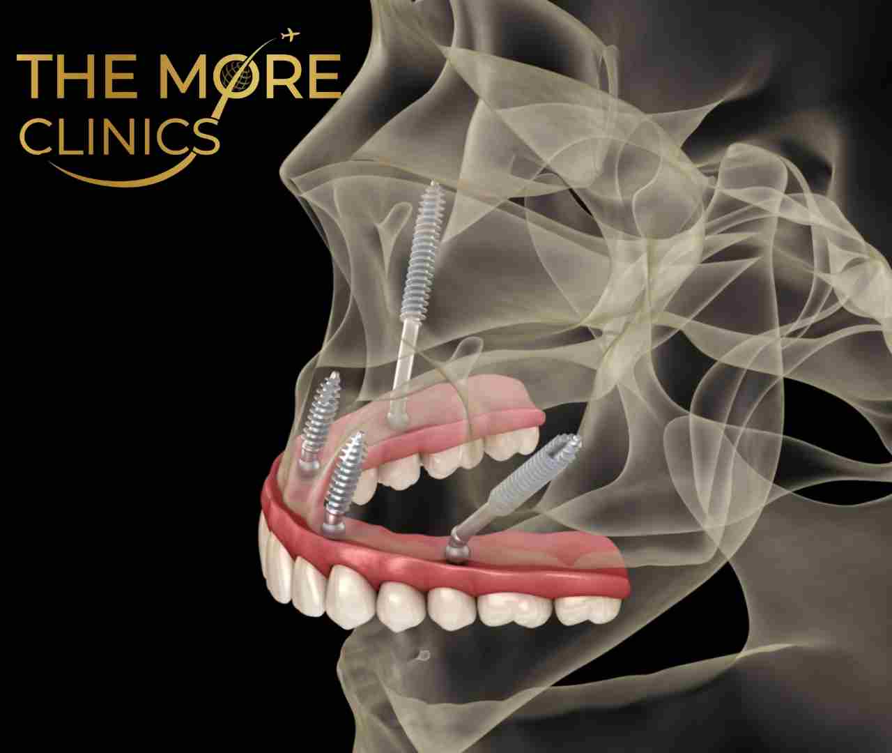 Zygomatic Implants Turkey - Before and After & Cost & Details