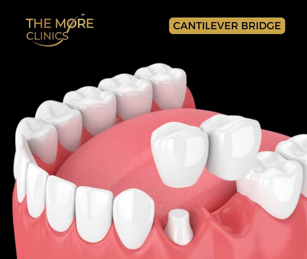 Types of Dental Bridge & Cost Comparison - The More Clinics Turkey
