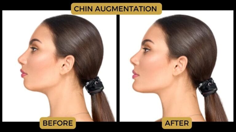 Genioplasty (Chin Augmentation) Types, Cost Turkey Option - The More ...