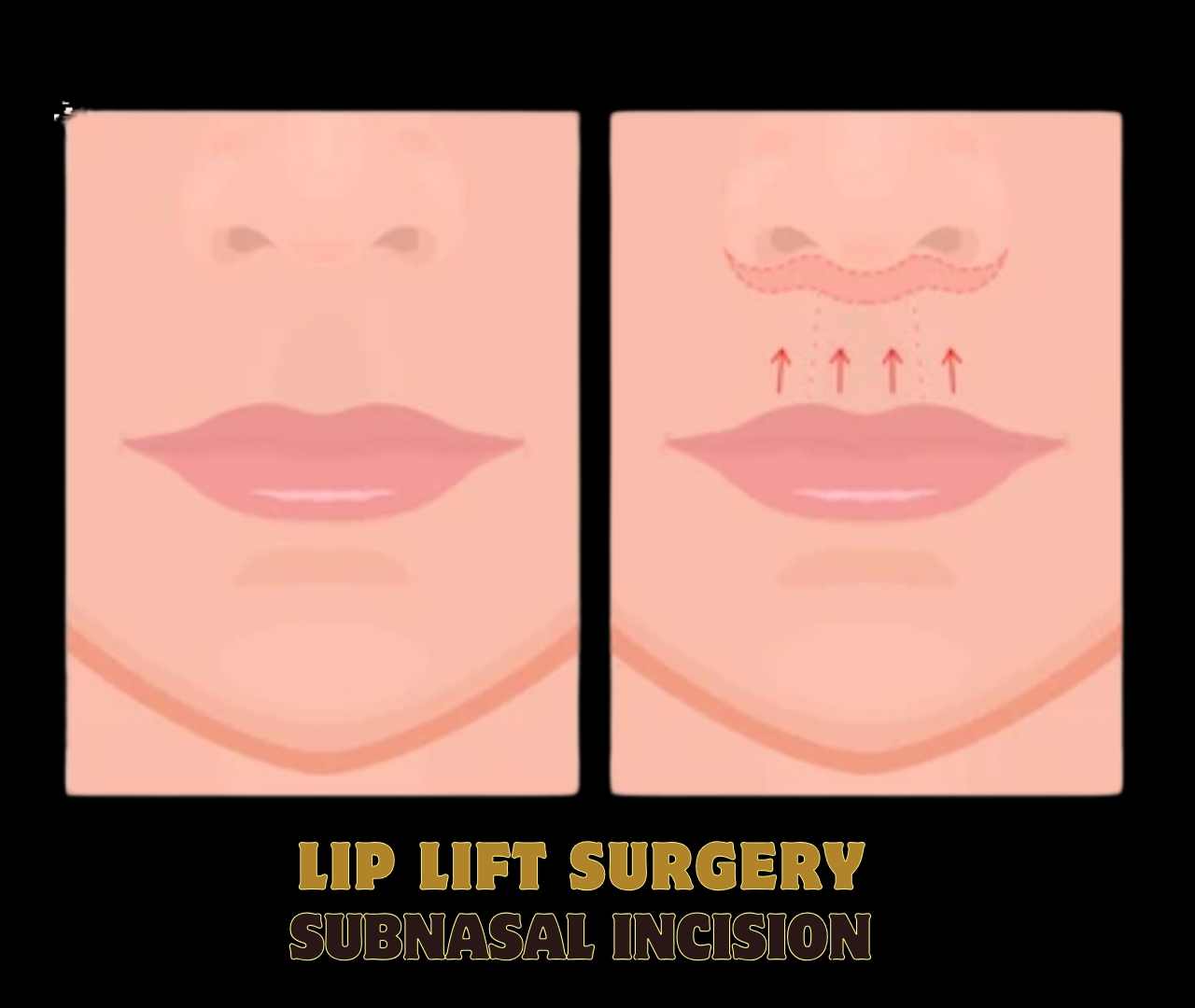 Lip Lift Surgery Cost, Before and After Results, Turkey Price Option