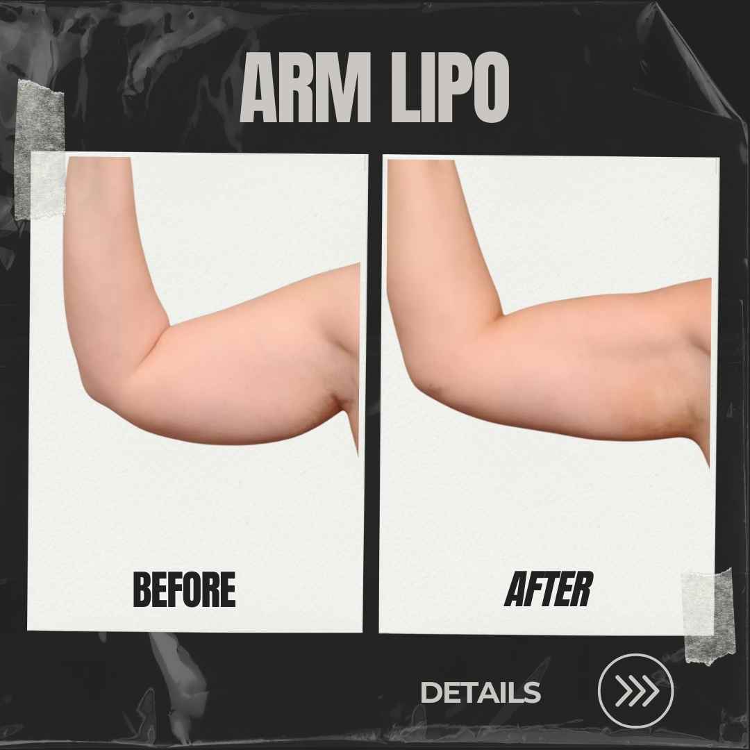 Liposuction Before and After from Tummy, Arms to Chin and Leg